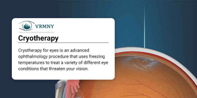 Cryotherapy Eye in NYC - Vitreous Retina Macula Consultants of New York