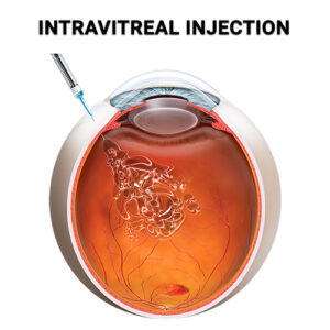 Intravitreal Injection - Vitreous Retina Macula Consultants of New York