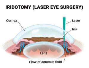 Iridotomy (Laser Eye Surgery) in NYC - Vitreous Retina Macula ...