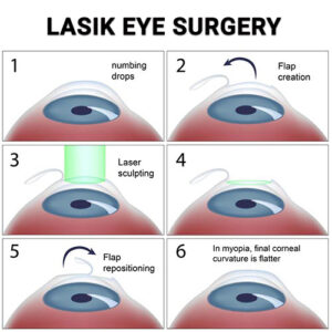 LASIK Eye Surgery in NYC - Vitreous Retina Macula Consultants of New York
