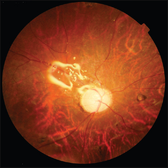 Silicone Oil Vitreous Retina Macula Consultants Of New York
