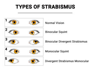 Strabismus (Crossed Eyes) NYC - Treatments For Ocular Misalignment