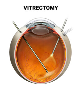 Vitrectomy Surgery in New York | Vitreoretinal Specialists