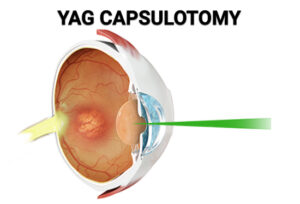 YAG Capsulotomy (YAG Laser Eye Surgery) - Vitreous Retina Macula ...