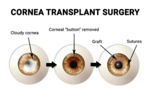 Cornea Transplant NYC - Vitreous Retina Macula Consultants of New York