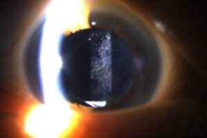 YAG Capsulotomy (YAG Laser Eye Surgery) - Vitreous Retina Macula ...