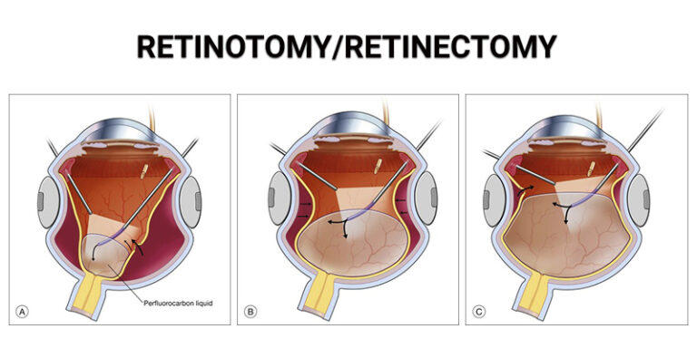 Retinotomy/Retinectomy in NYC - Vitreous Retina Macula Consultants of ...