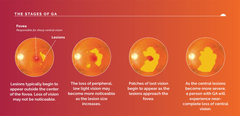 Syfovre Injection - Vitreous Retina Macula Consultants of New York